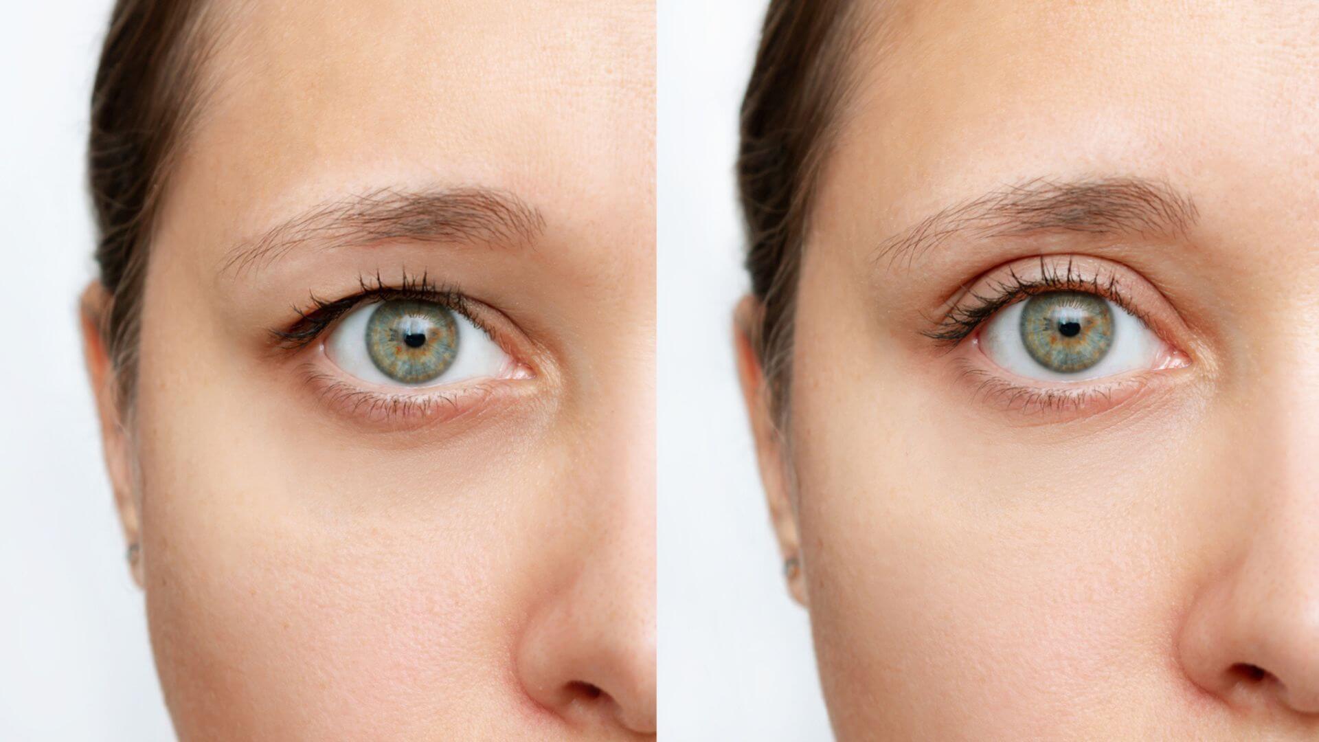 Blefaroplastia | HMO - Hospital Medicina dos Olhos
