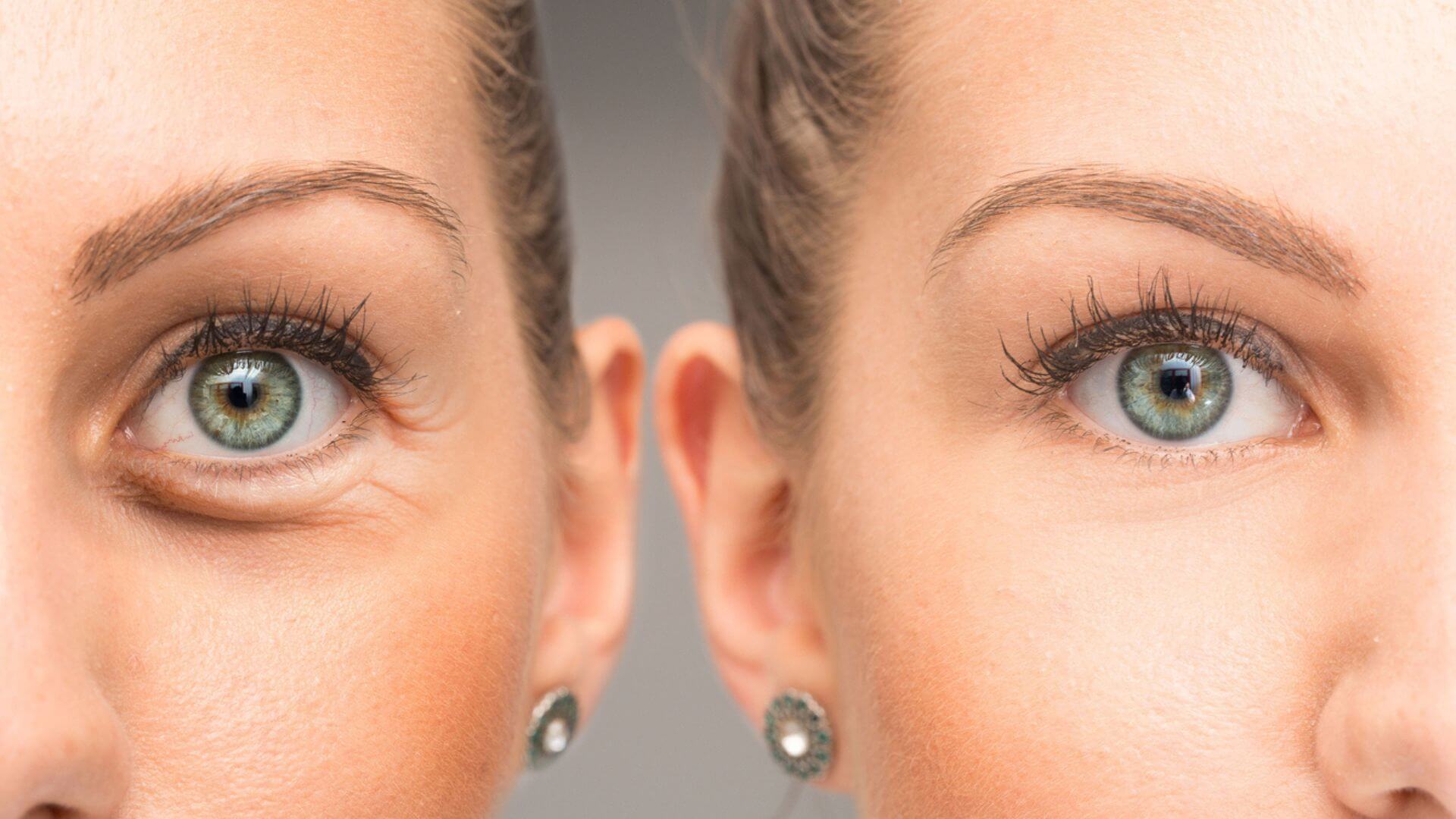 Blefaroplastia | HMO - Hospital Medicina dos Olhos